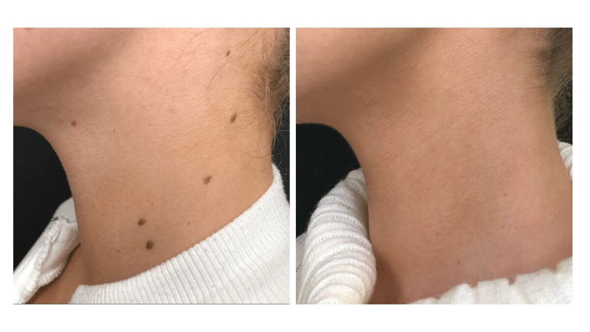 Dermatologist or Cosmetic Surgeon for Mole Removal? - Mole Removal San ...